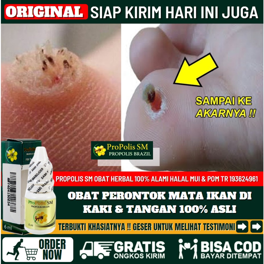 Jual [ BISA COD ] OBAT PERONTOK MATA IKAN / CLAVUS 100% ALAMI - OBAT ...