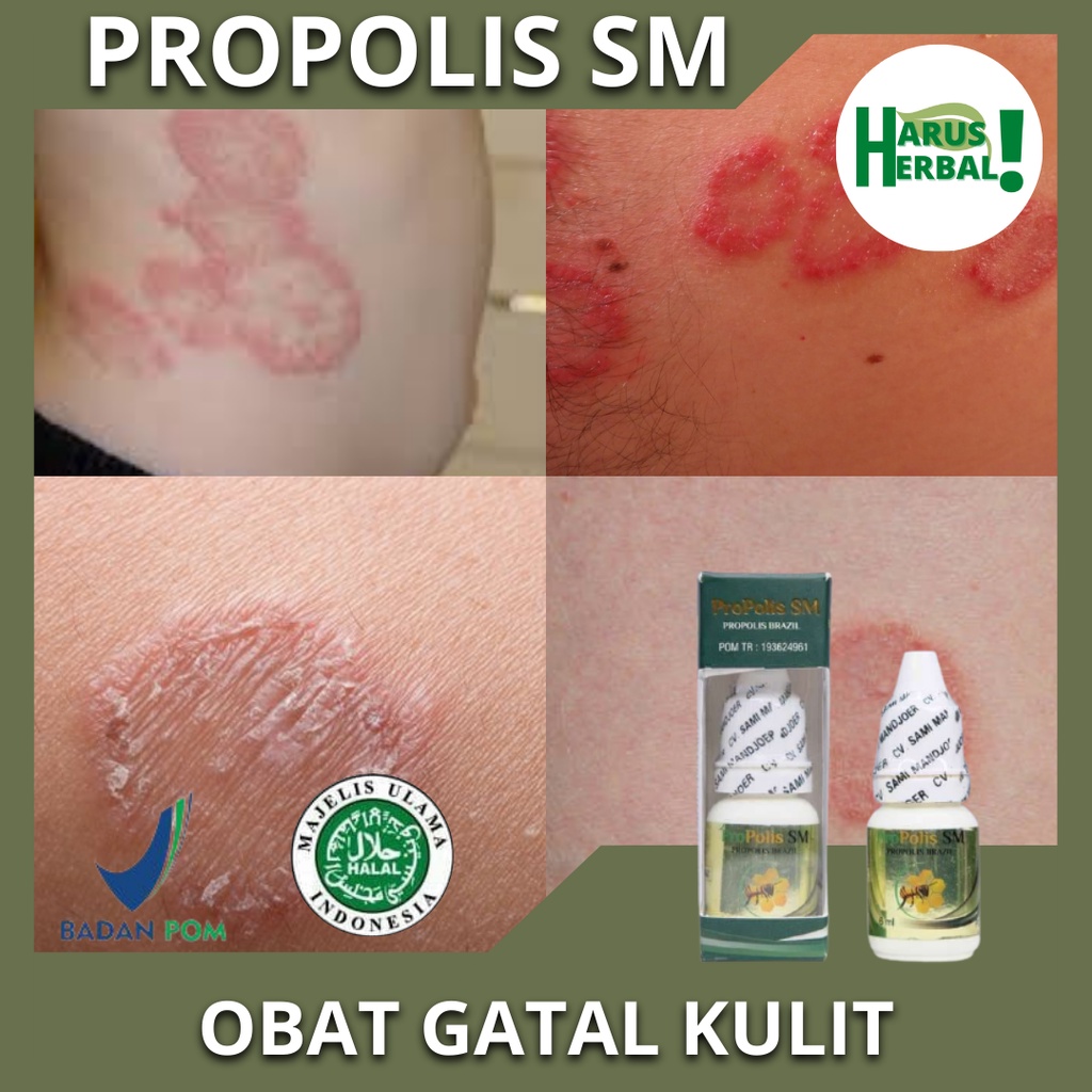 Jual Obat Alami Kurap Kadas, Obat Panu, Obat Kudis Skabies Scabies ...