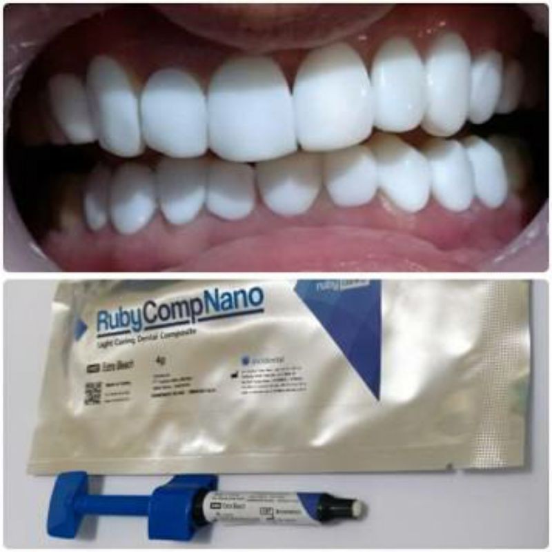 Jual Ruby Komposite Extrawhite / Veneer (composite veneer) | Shopee Indonesia