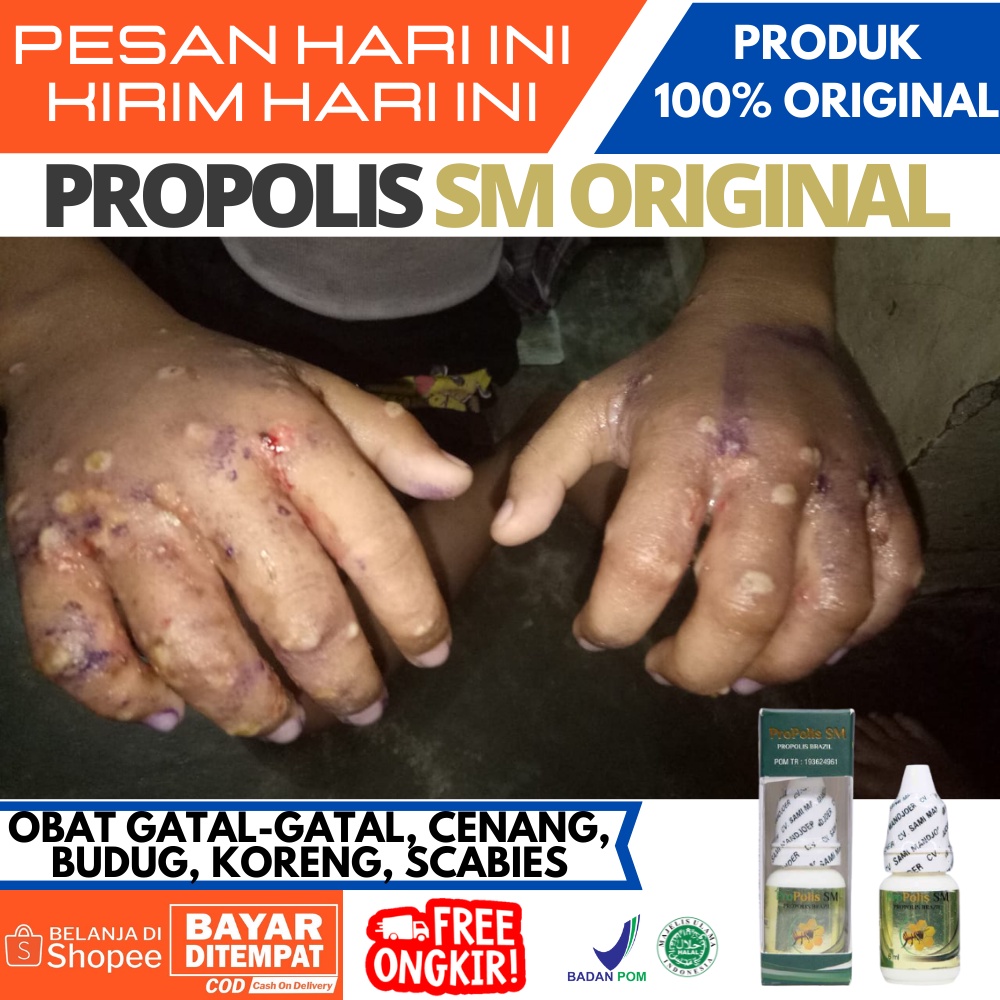 Jual Obat Oles Salep Cenang, Budug, Bisul, Borok, Luka Koreng Basah ...