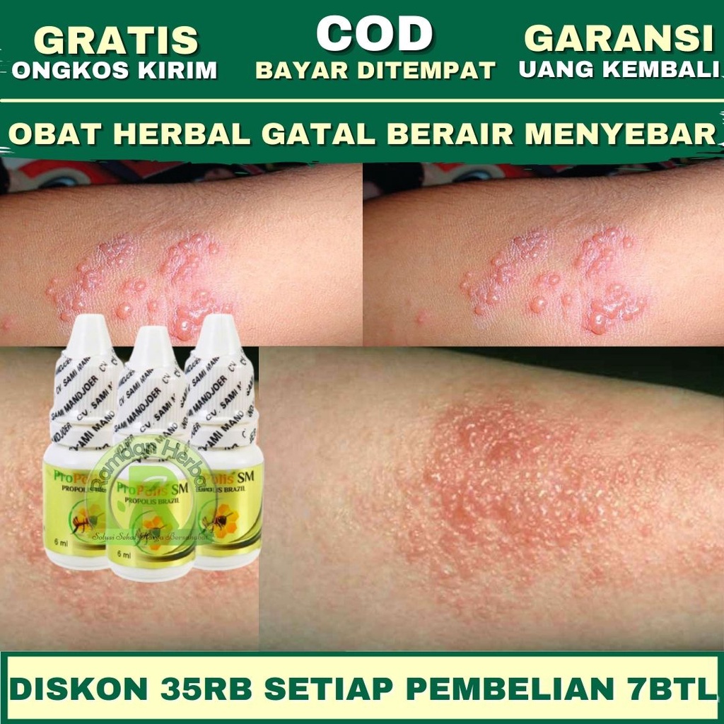 Jual Obat Gatel Berair dan Menyebar Bruntusan Gatel Kuman Air Jamur ...