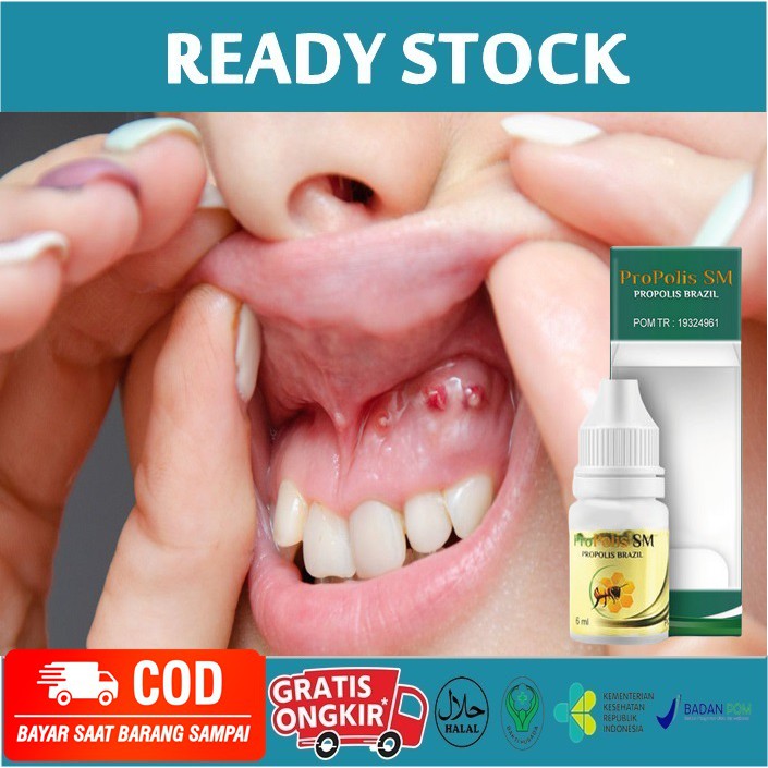 Jual Obat Gusi Bengkak, Nyeri Gusi, Gusi Berdarah, Gusi Bernanah, Obat ...