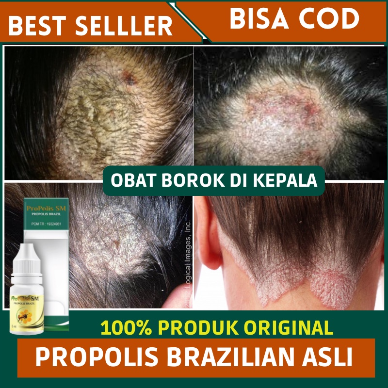 Jual Obat Borok Kepala - Infeksi Jamur Kulit Kepala - Tinea Capitis - Korengan Propolis ...