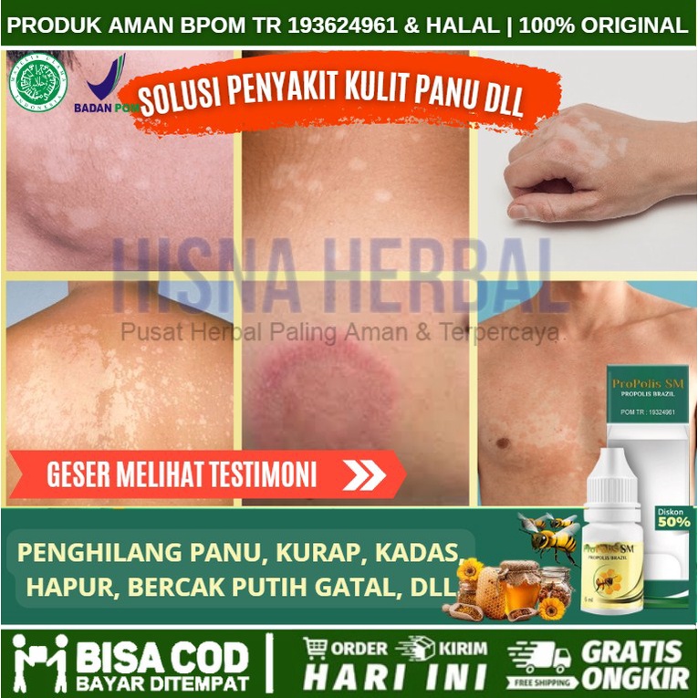 Jual OBAT PANU DI WAJAH ANAK BAYI DAN DEWASA, MENGHILANGKAN PANUAN PADA ...