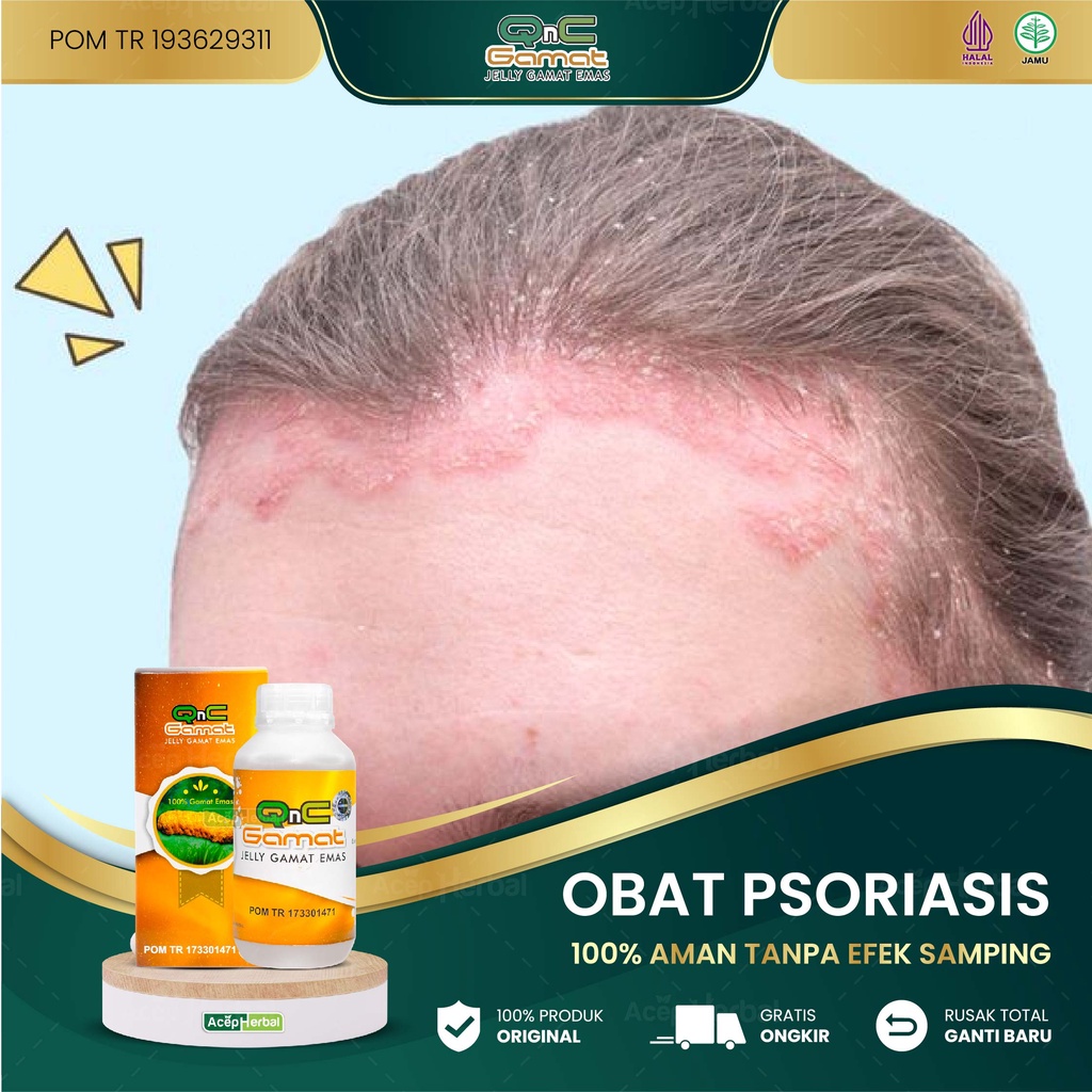 Jual Obat Psoriasis Gatal Kulit Kepala Ketombe Berkerak Kulit Kepala Gatal Gatal Karena Jamur ...