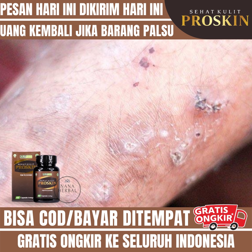 Jual OBAT KAKI KORENGAN, OBAT MENGHILANGKAN KORENG, OBAT BUDUG CENANG ...