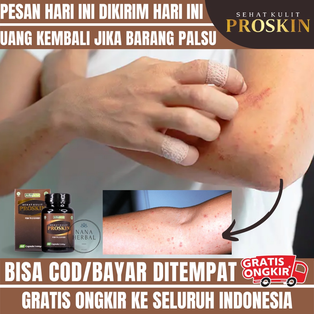 Jual OBAT PENGHILANG BINTIK GATAL DI TANGAN DAN KAKI, GATAL BERAIR ...