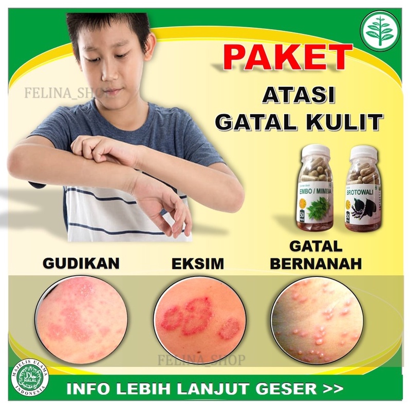 Jual obat eksim kering exim basah penyakit kulit gatal parah alergi ...