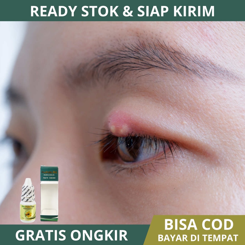 Jual Obat Mata Bintitan, Obat Buat Mata Bintitan, Timbilen, Cindilen ...