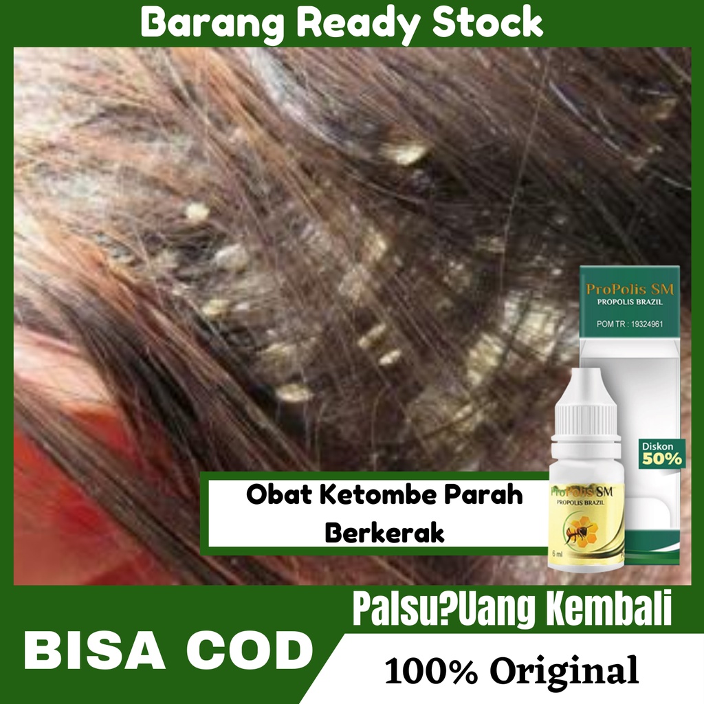 Jual Obat Ketombe Parah Berkerak , Koreng Di Kepala , Dermatitis Seboroik , Bercak Merah Di ...
