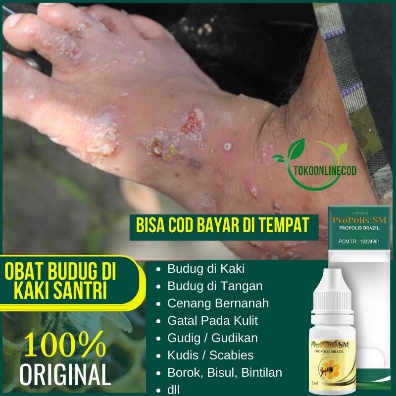 Jual Obat Budug di Kaki Santri, Cenang Bernanah, Gatal Kulit Anak ...