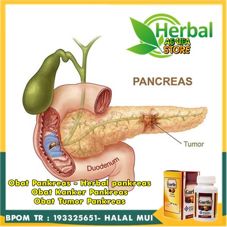 Jual Obat Pankreas - Herbal pankreas / Obat Kanker Pankreas - Obat ...