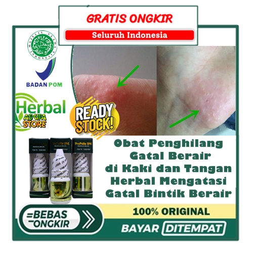 Jual Obat Penghilang Gatal Berair di Kaki dan Tangan | Herbal Mengatasi ...