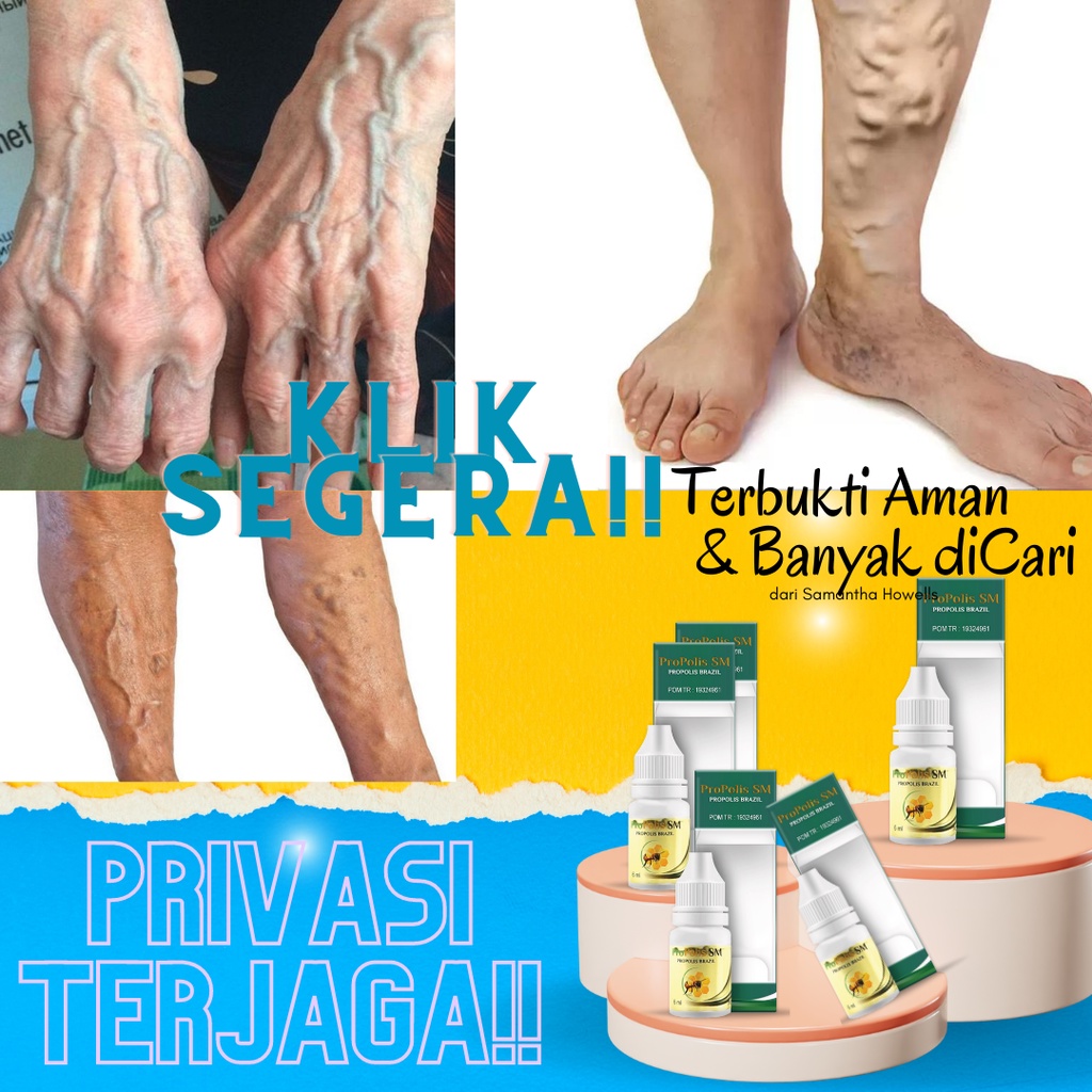 Jual Obat Varises, Farises, Parises, Obat Varises di Kaki dan Betis ...