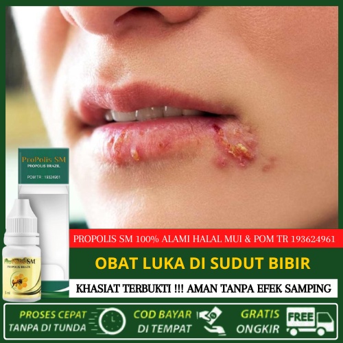 Jual Obat Luka Di Sudut Bibir, Angular Cheilitis, Luka Ujung Bibir, Luka Dibibir Kanan Dan Kiri ...