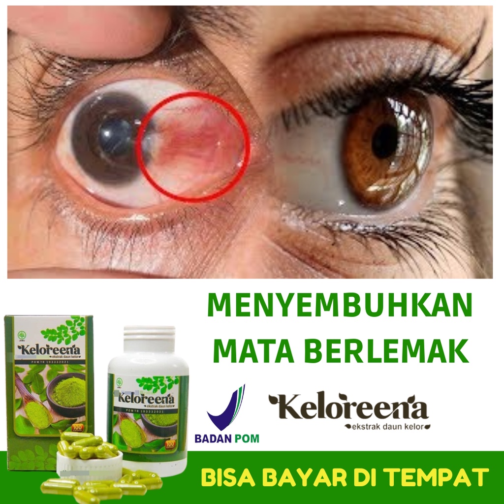 Jual Obat Mata Berlemak Bercak Merah di kelopak mata, Mata Gatal dan ...