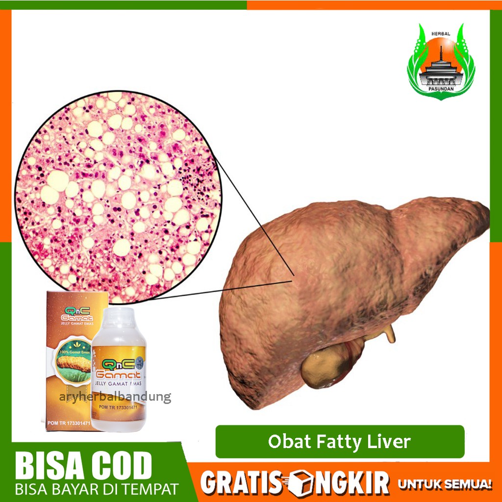 Jual Obat Hati Berlemak Fatty Liver - Obesitas Diabetes Gejala ...