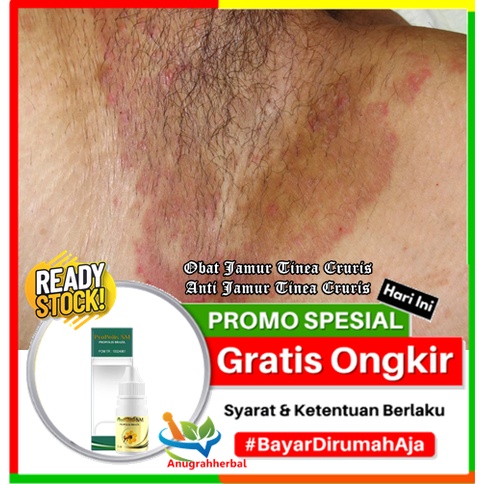 Jual Obat Jamur Tinea Cruris, Obat Anti Jamur Tinea Cruris, Penghilang ...