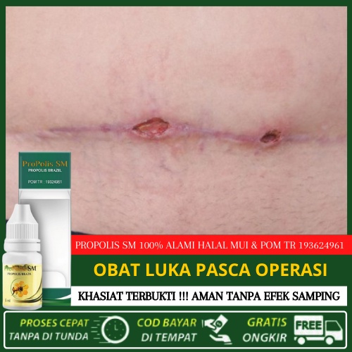 Jual Obat Pengering Luka Pasca Operasi Cesar, Salep Luka Sesar Sobek ...