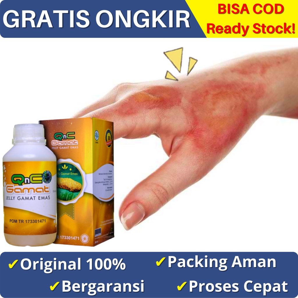 Jual Obat Luka Bakar Kulit Melepuh, Luka Kenalpot, Luka Bakar Kena ...