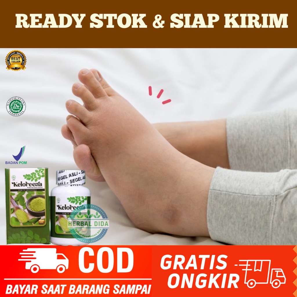 Jual Obat Herbal Kaki Bengkak, Obat Kaki Bengkak Asam Urat, Obat ...