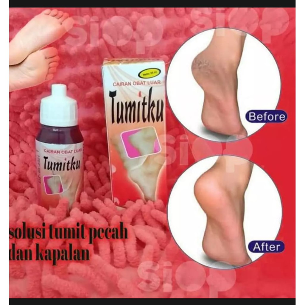 Jual Tumitku Obat Kaki Pecah Kapalan Penghalus Tumit Kaki Obat Kapalan ...