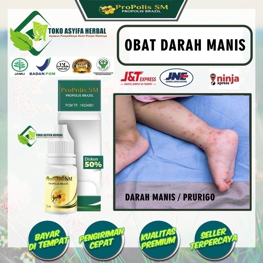 Jual Obat Darah Manis, Obat Amis Daging, Obat Budug Santri, Eksim ...