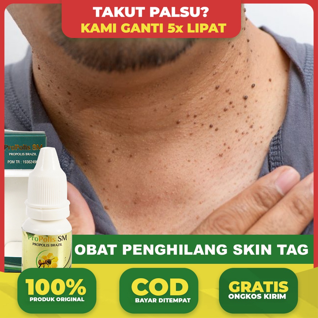 Jual Obat Peghilang Skin Tag - Penghilang Daging Jadi - Matak Ikan ...
