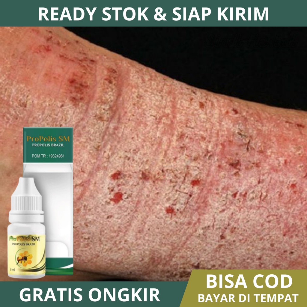 Jual Obat Eksim Kering Menahun, Obat Eksim Basah Dan Kering Menahun ...