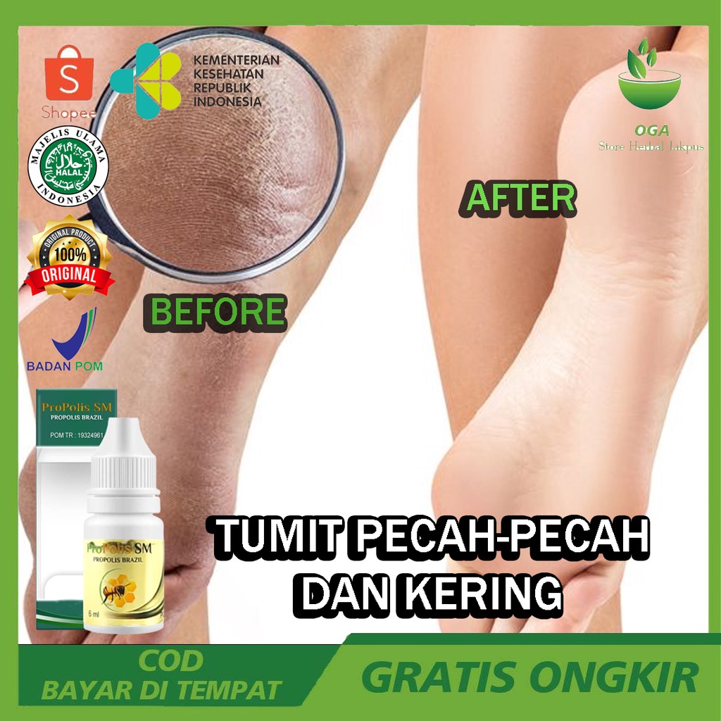 Jual Obat Tumit Pecah Dan Kering Cream Kaki Pecah2 Penghalus Kapalan ...