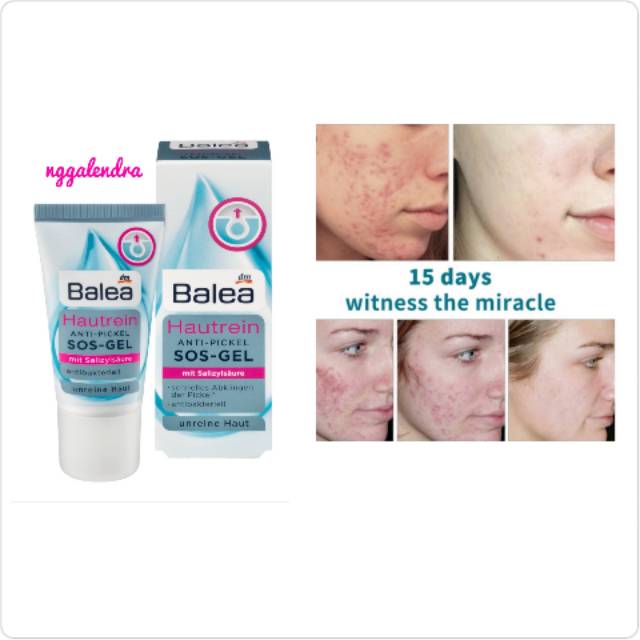 Jual BALEA Anti Acne SOS Gel | Shopee Indonesia