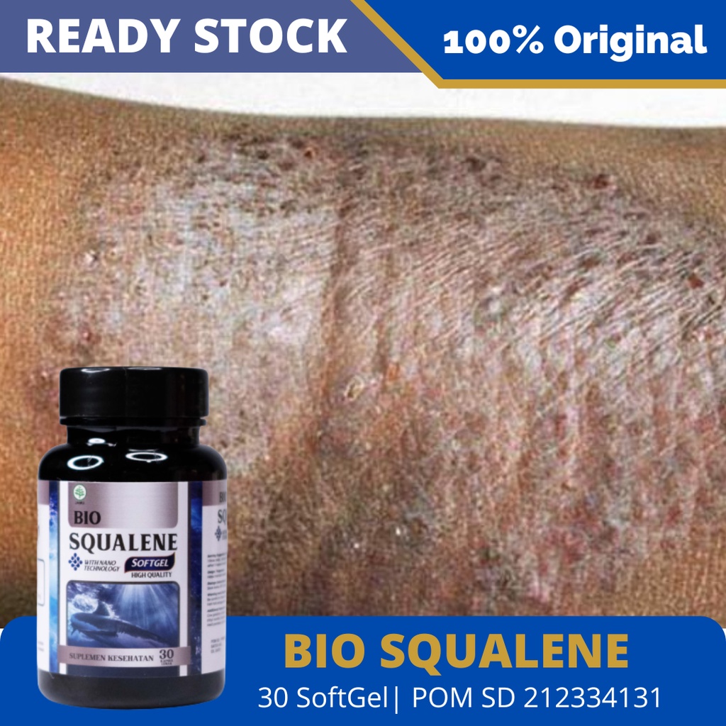 Jual Obat Eksim Kering Herbal - Salep Eksim - Obat Exim - Obat Eksim ...