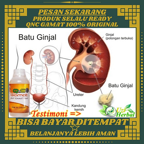 Jual Obat Penghancur Batu Ginjal, Batu Empedu, Batu Ureter, Kencing Batu, Obat Fungsi Ginjal ...