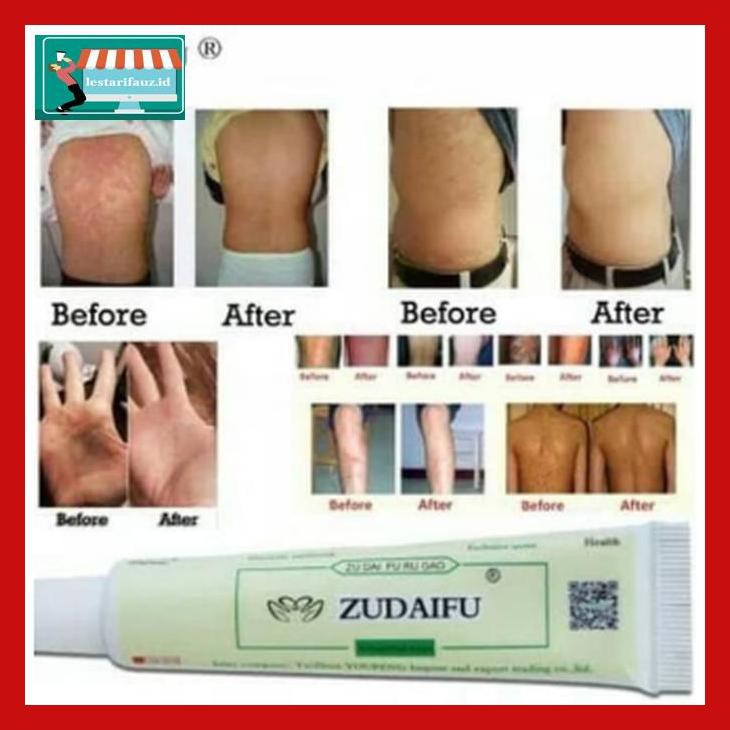 Jual 45Rfet7- Zudaifu Cream Obat Kulit Jerawat Ruam Jamur Kudis Kurap ...