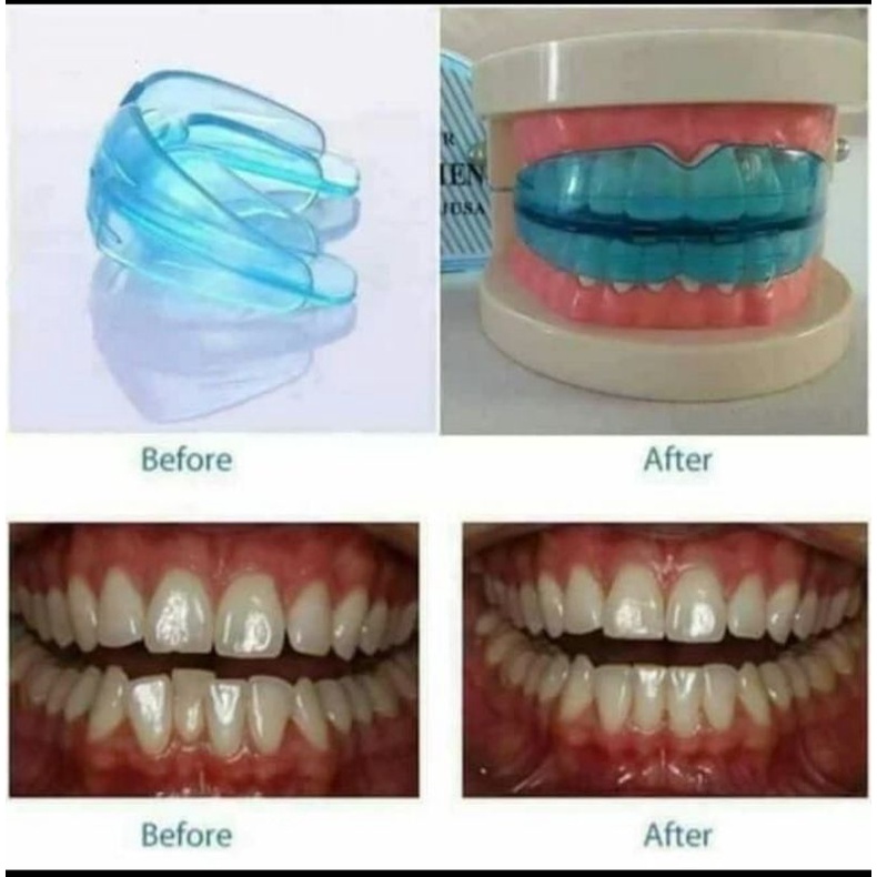 Jual Alat Perapi/Perata Gigi | Shopee Indonesia