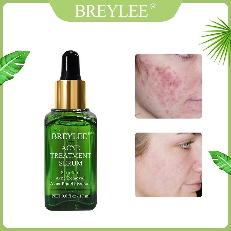 Jual AS Breylee Acne Treatment Serum Tea Tree Oil Acne Removal and Pimple Repai 17 ML | Shopee ...