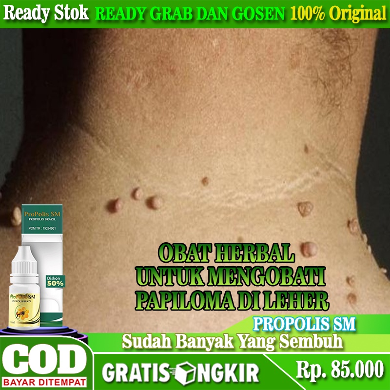 Jual Obat Papiloma di Leher dan Wajah, Obat Kutil di Leher Papiloma ...
