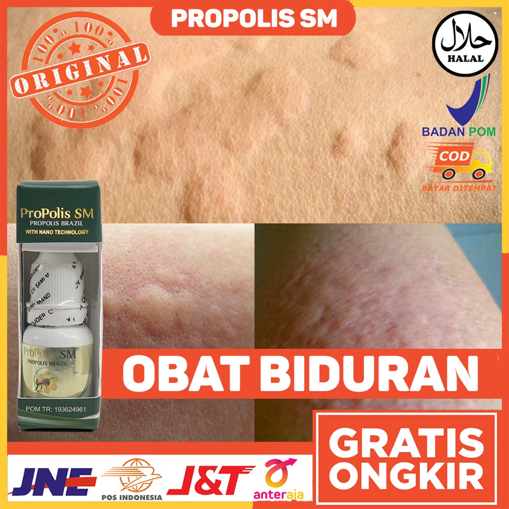 Jual Obat Biduran Bentol Kulit Gatal Alergi Kaligata Radang Kulit Ruam ...