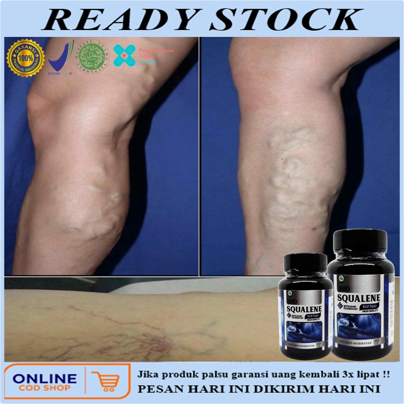 Jual Obat varises di tangan dan kaki, Obat Varises Di Tangan, Obat Urat ...