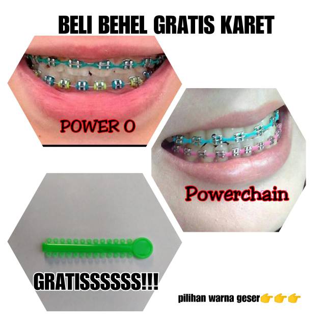 Jual [Bisa COD] Behel Lepas pasang // Behel Fashion Lepas Pasang ...