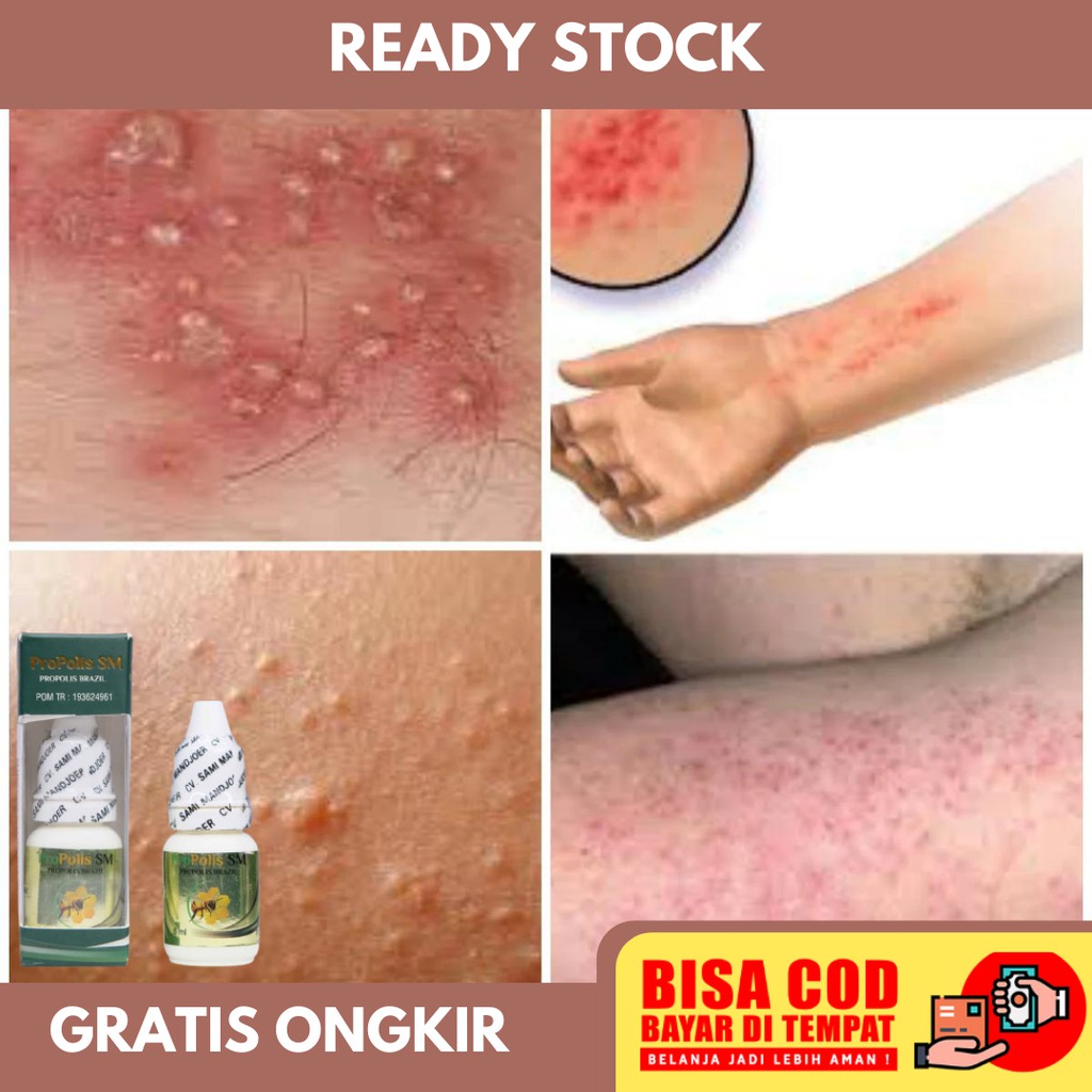 Jual Obat Gatal Berair Di Jari Tangan dan Kaki, Obat Gatal Bintik ...