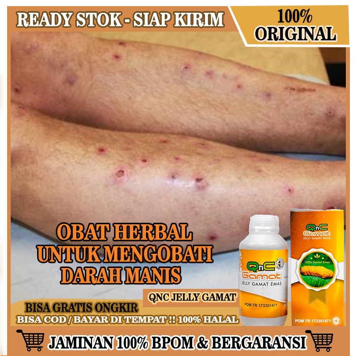 Jual Obat Darah Manis, Obat Prurigo, Obat Kulit Gatal-Gatal, Solusi ...