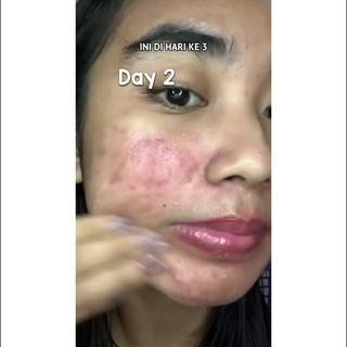 Jual GLOW FX Acne Pure Serum - Serum Untuk Jerawat Meradang | Shopee ...