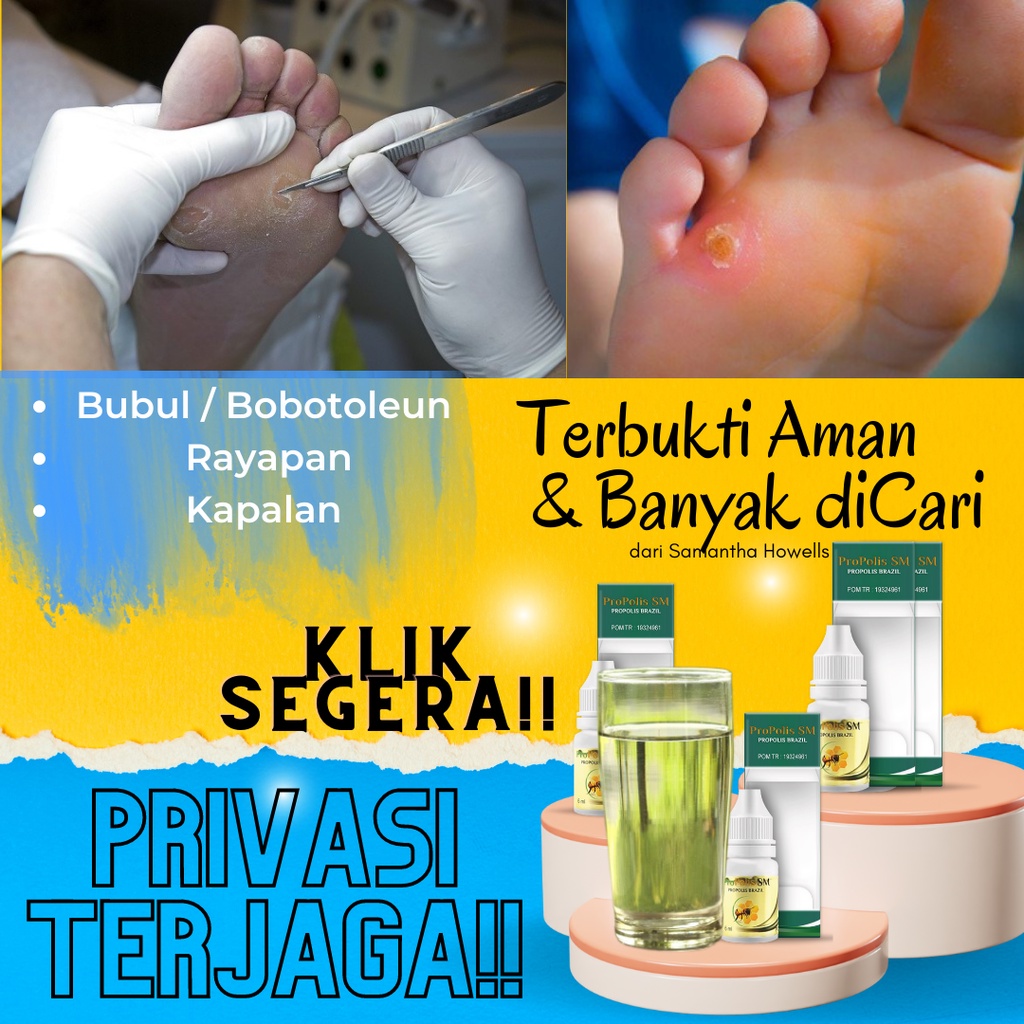 Jual Obat Bobotoleun kaki / di Telapak Kaki, Obat Bubul di Telapak Kaki ...