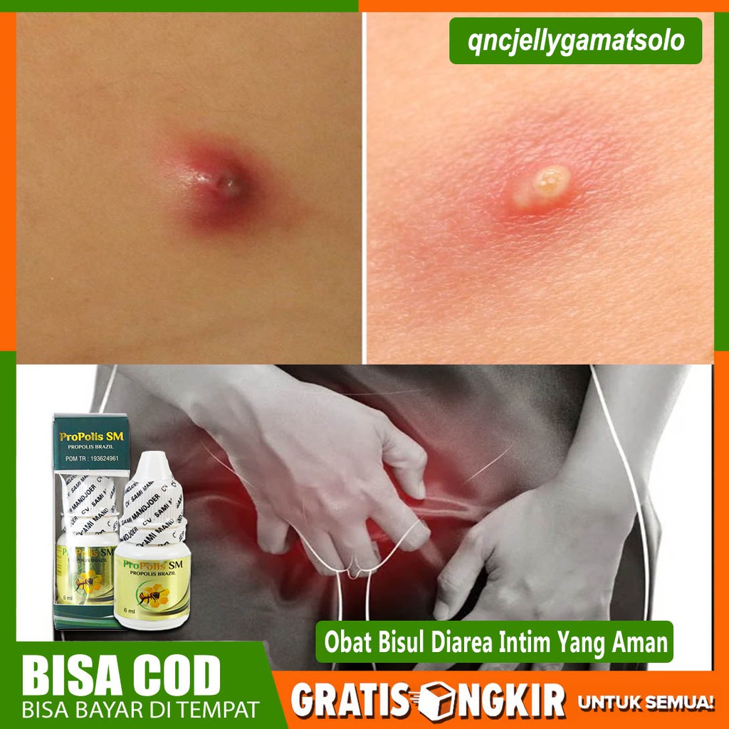Jual Obat Bisul - Cenang - Bisul di Area Intim - Bernanah - Kutu Air ...
