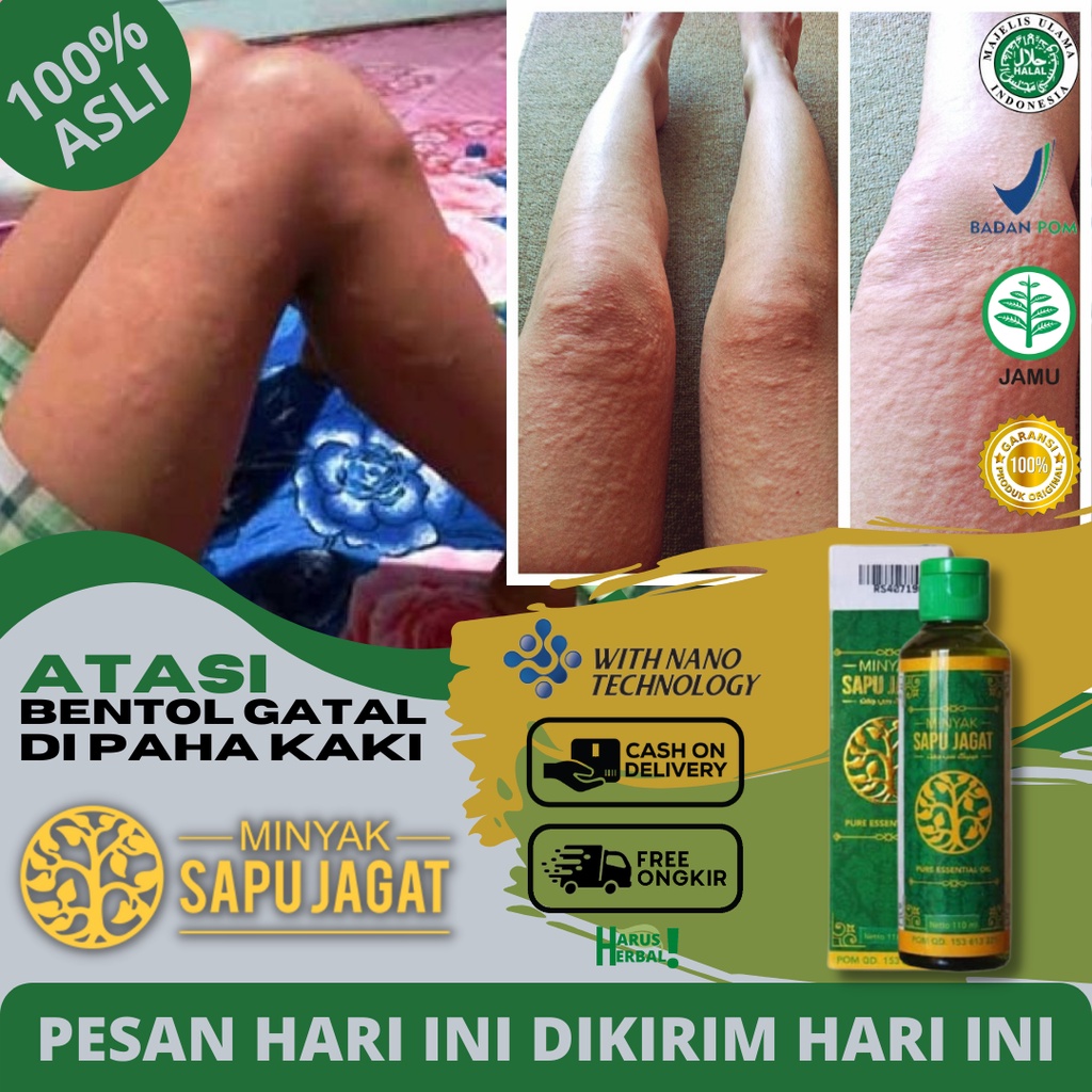 Jual Obat Bentol Gatal Di Paha, Obat Balur Pereda Gatal Alergi, Gatal ...