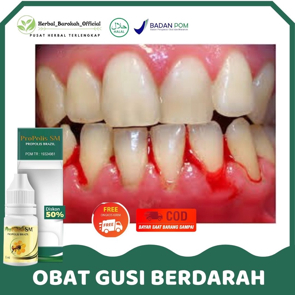 Jual Obat Gusi Berdarah , Benjolan Di Gusi , Nyeri Saat Menggigit ...