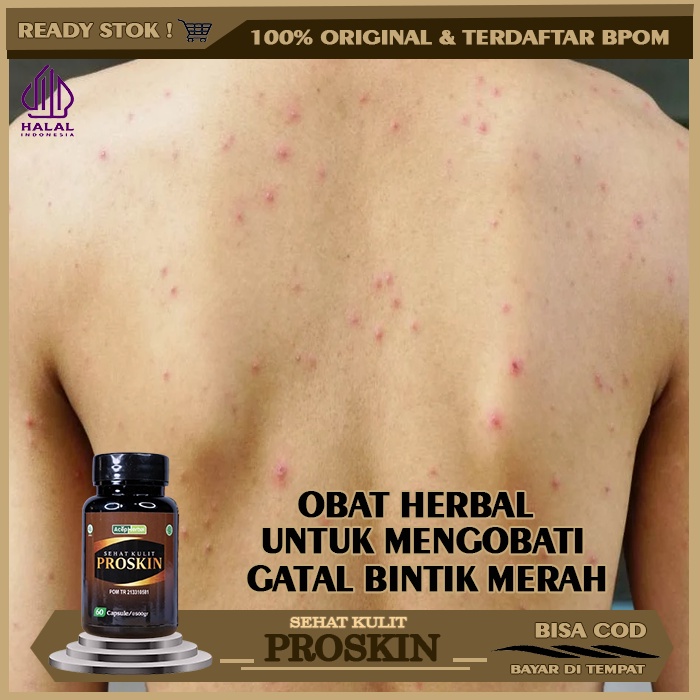 Jual Obat Gatal & Bintik Merah Diseluruh Tubuh, Penghilang Gatal di ...