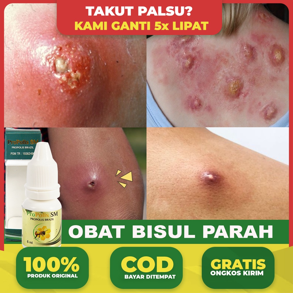 Jual PROPOLIS SM 100% ASLI - Obat Bisul Parah - Bisul Bengkak ,Bernanah ...
