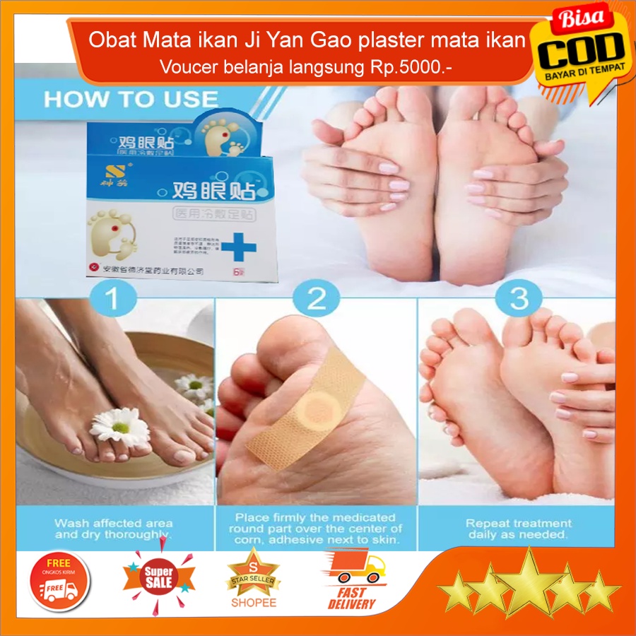 Jual Obat Mata ikan Ji Yan Gao plaster mata ikan plester kutil dan ...